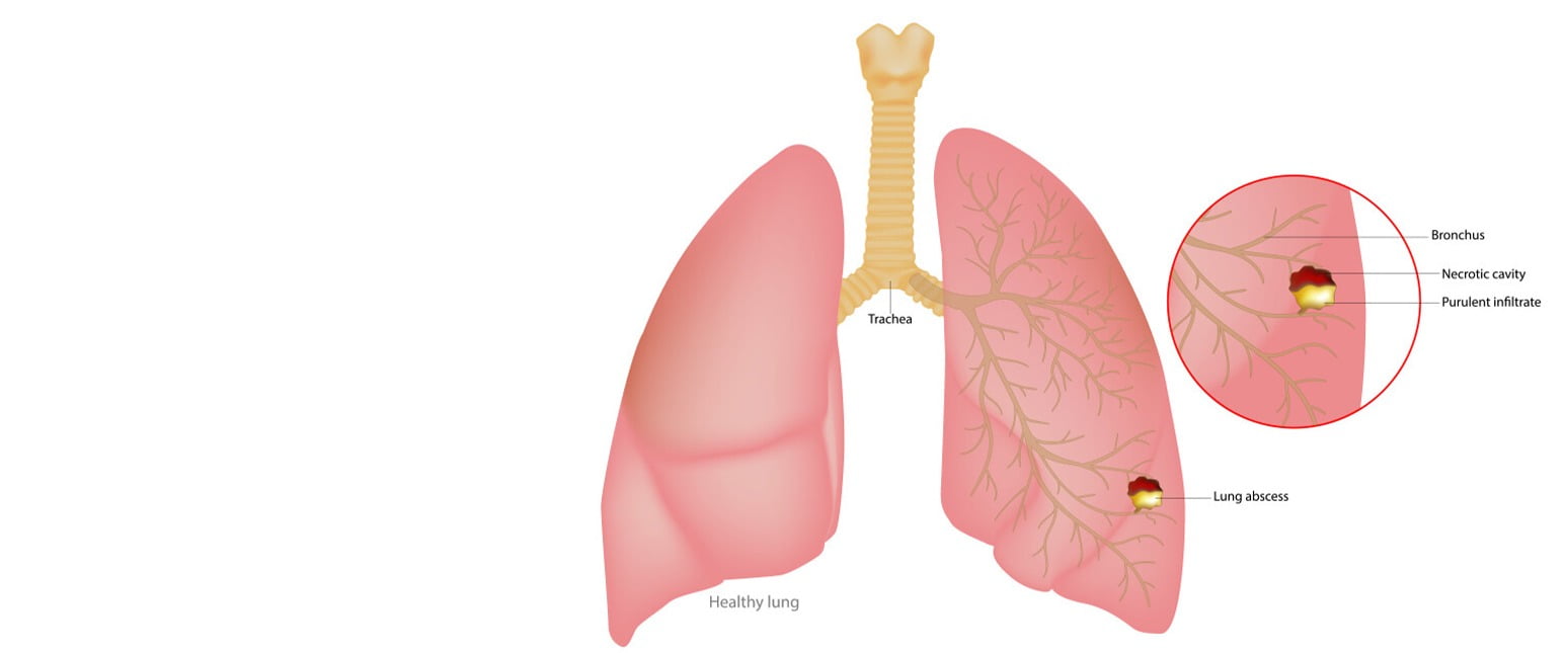 Lung Abscess Amandeephospital